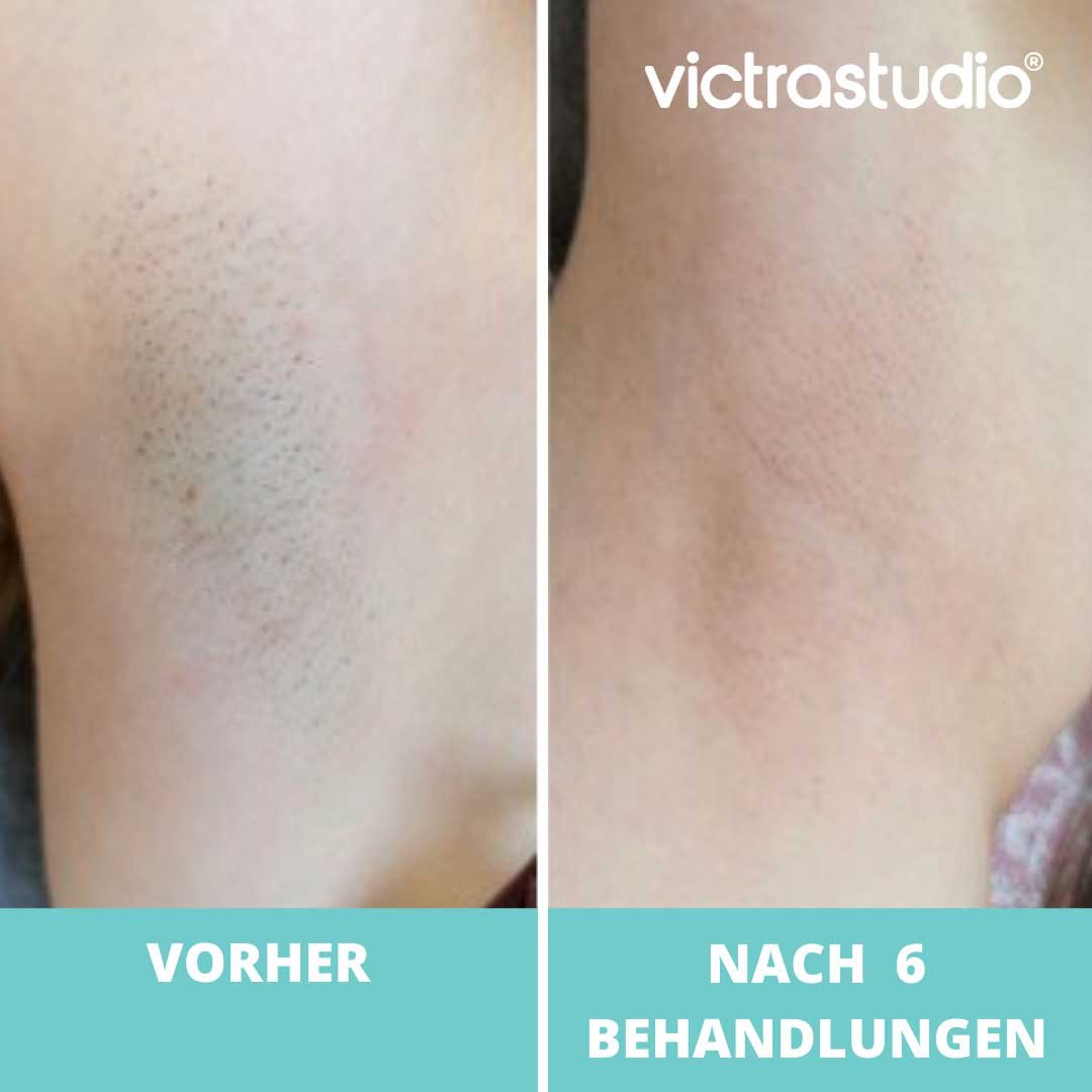 Laserhaarentfernung Achsel - Victrastudio